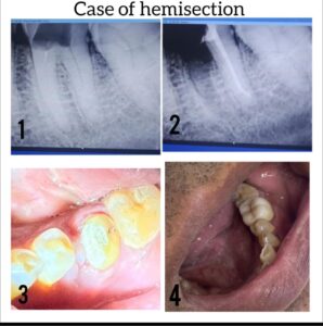 Tooth Hemisection: An Approach to Save Compromised Molars - Oral Health ...