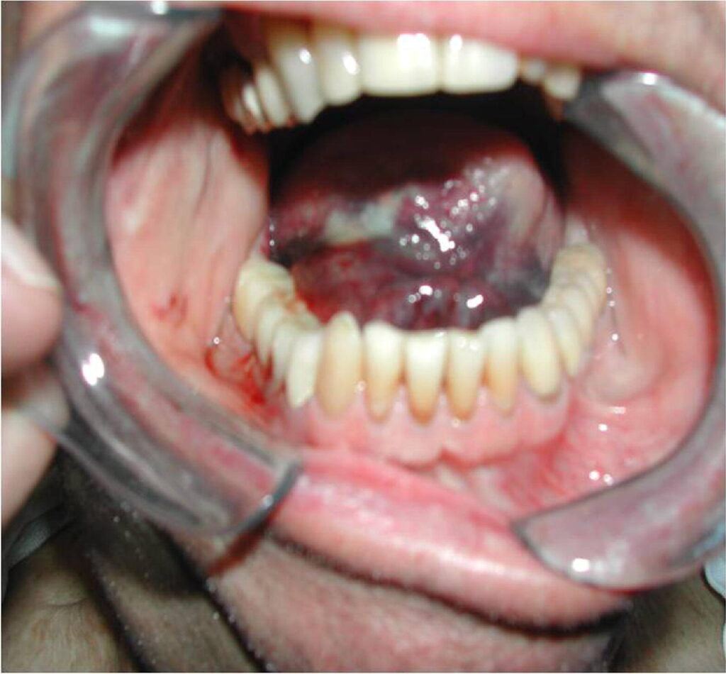 Managing Oral Hematoma - Oral Health Insights